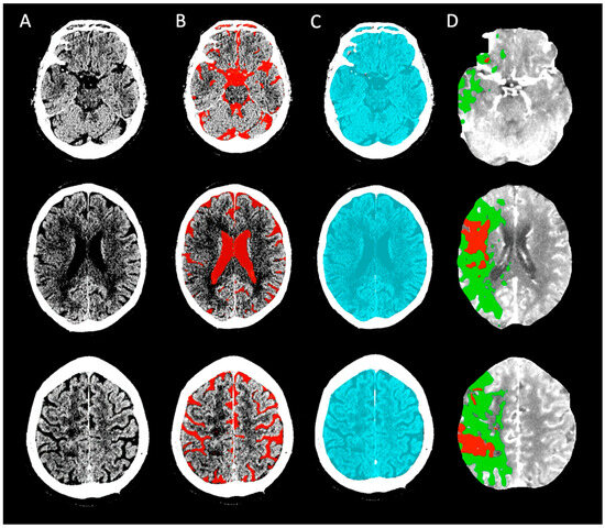 Impact of Intracranial Volume and Brain Volume on the Prognostic Value ...