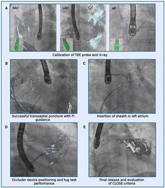 JCDD | Free Full-Text | Echocardiographic-Fluoroscopic Fusion Imaging ...