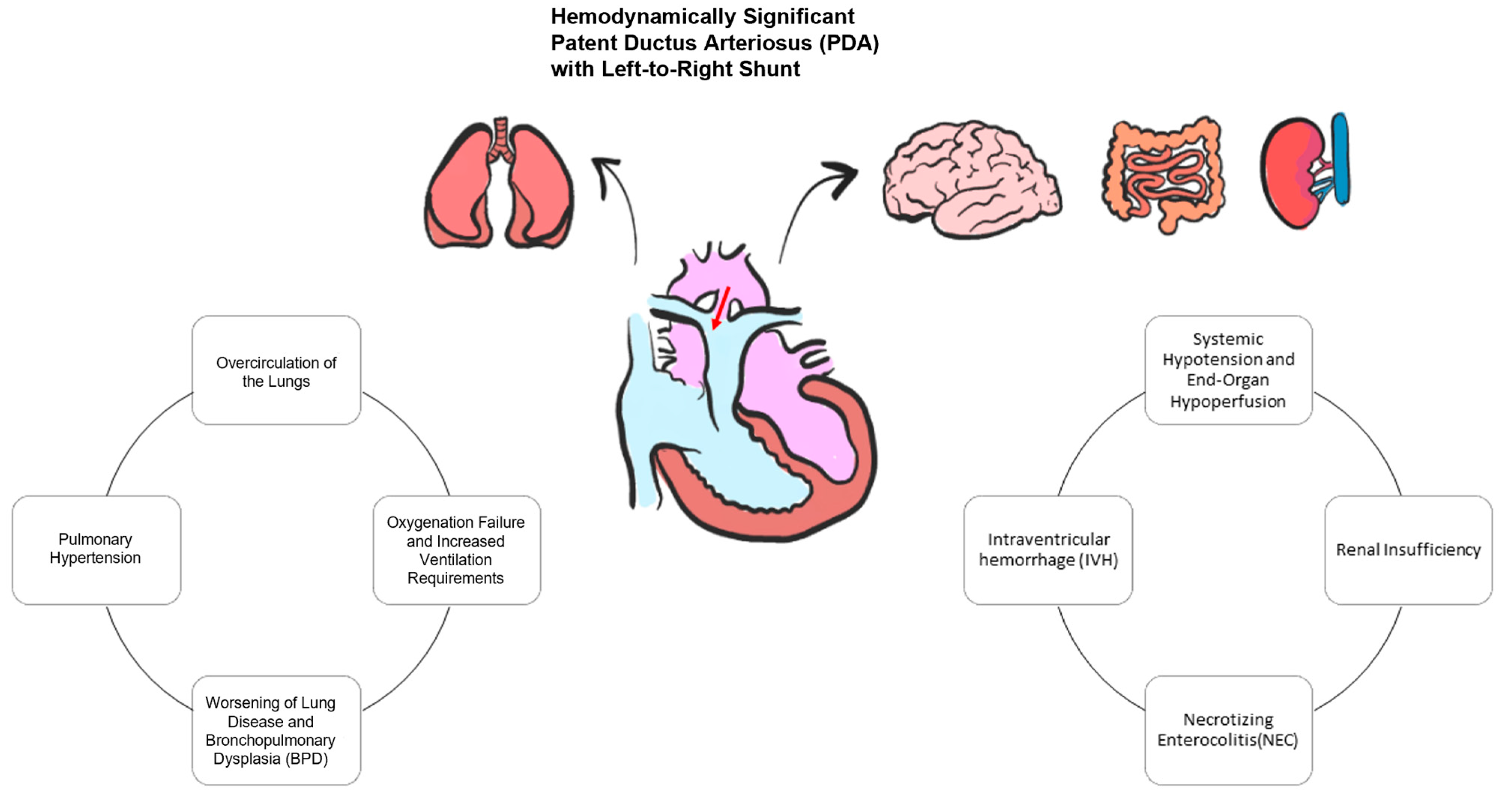 Us Indicators Of Surgical Treatment Of Patent Ductus Arteriosus In