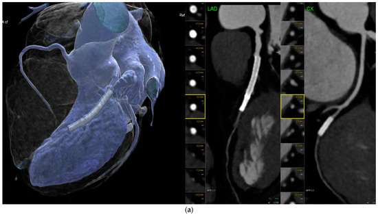 Photon-Counting Detector Computed Tomography (PCD-CT): A New Era for ...