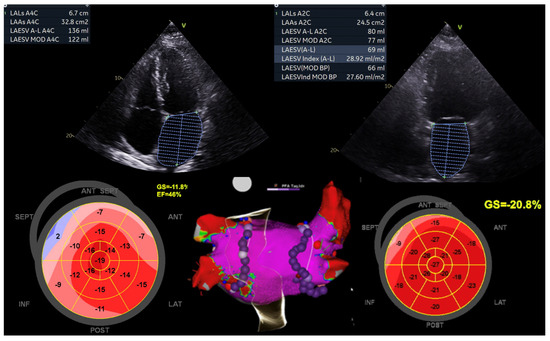 Heart Failure with Mildly Reduced Ejection Fraction—A Phenotype Waiting ...