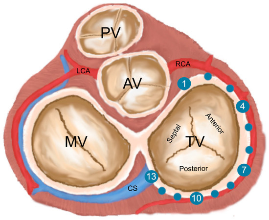 The Right Coronary Anatomy and Operative Topography of the Tricuspid ...