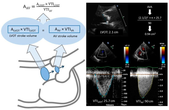 Diagnostic Challenges in Aortic Stenosis
