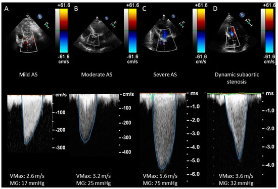 Diagnostic Challenges in Aortic Stenosis