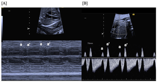 Diagnosis and Management of Fetal Arrhythmias in the Current Era