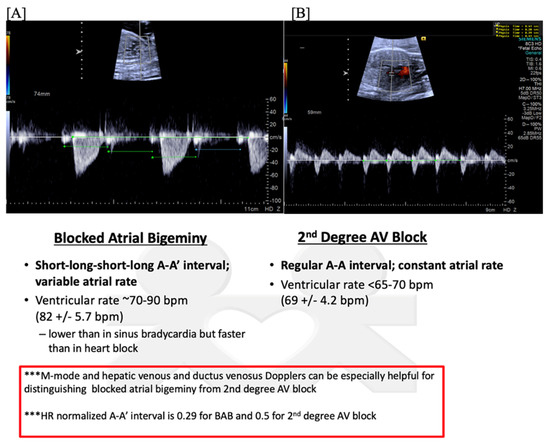 Diagnosis and Management of Fetal Arrhythmias in the Current Era