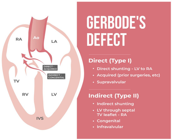 Congenital Gerbode Defect: A Left Ventricular to Right Atrial Shunt ...