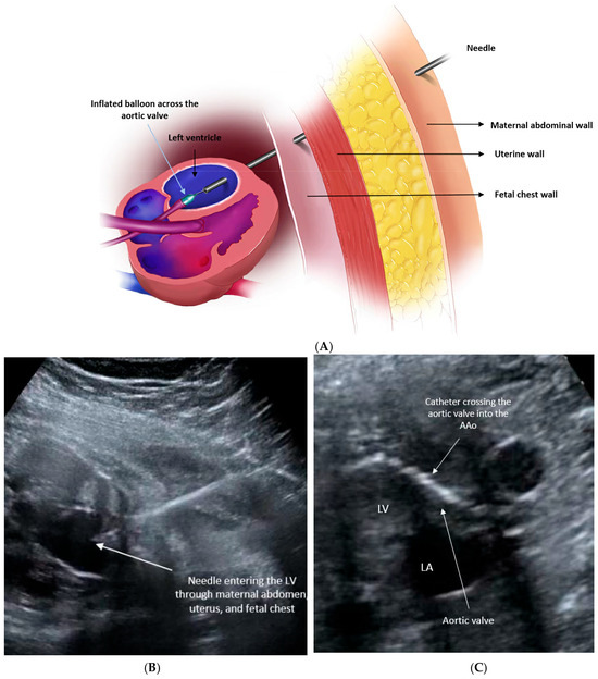 Catheter-Based Fetal Cardiac Interventions