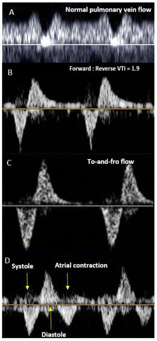 Catheter-Based Fetal Cardiac Interventions