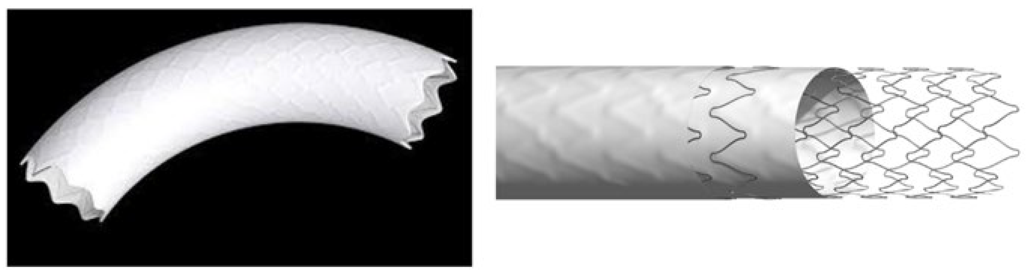 BeGraft Aortic Stents: A European Multi-Centre Experience Reporting ...