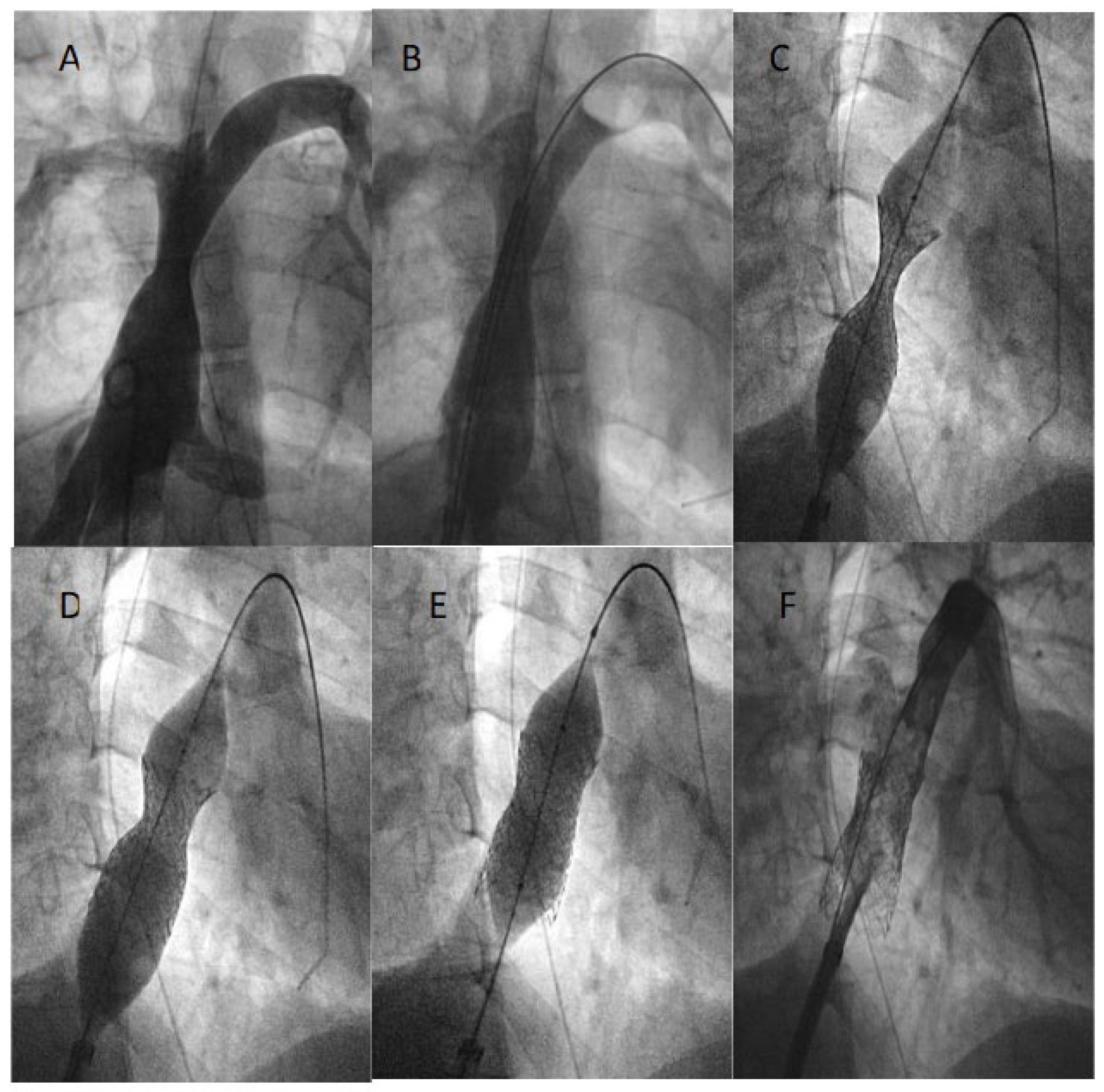 BeGraft Aortic Stents: A European Multi-Centre Experience Reporting ...