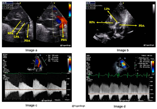 JCDD | Free Full-Text | Narrative Review on Echocardiographic ...