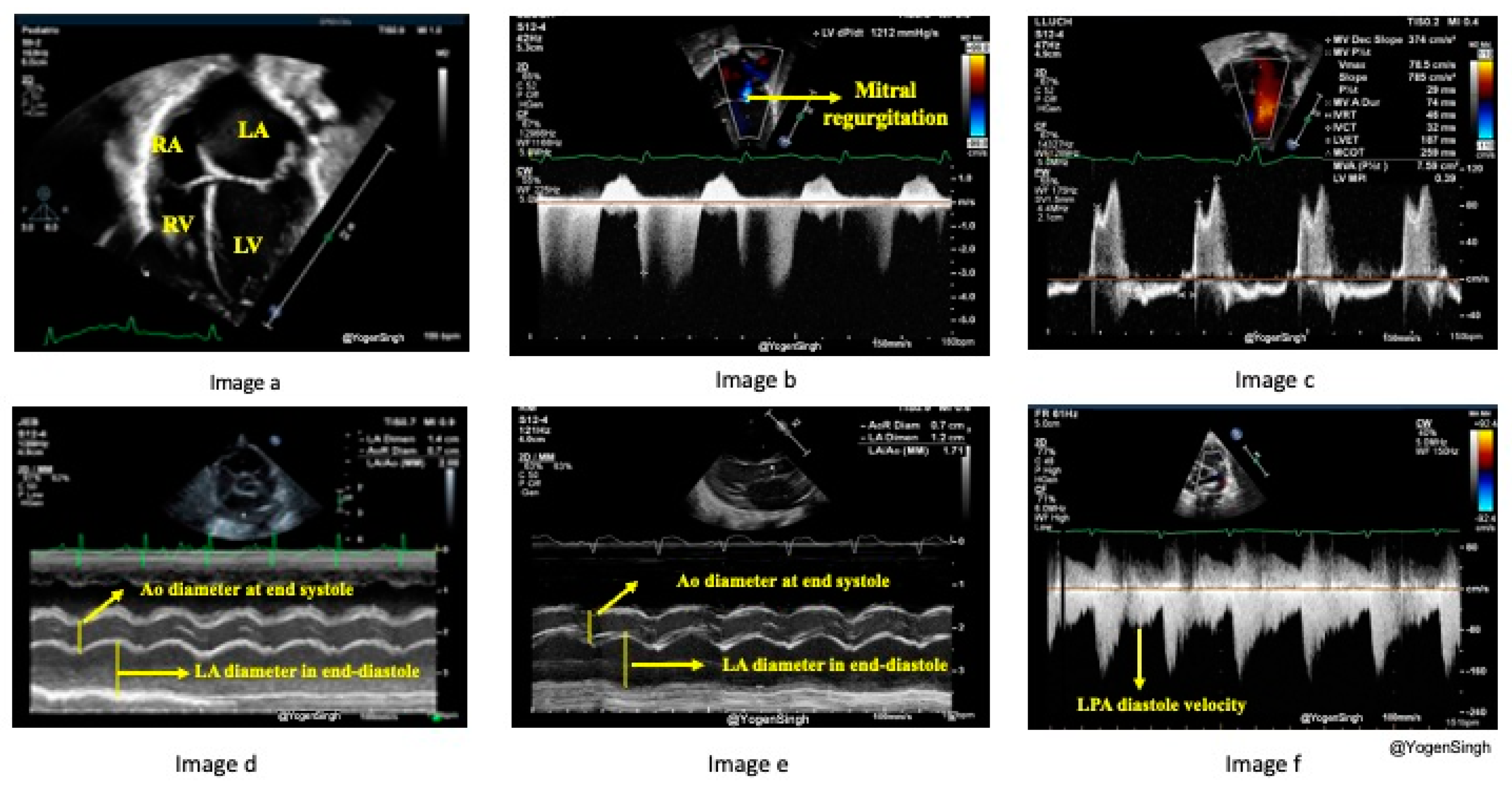 JCDD | Free Full-Text | Narrative Review on Echocardiographic ...