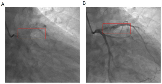 Elucidating the Relationship between Neutrophil–Lymphocyte Ratio and ...