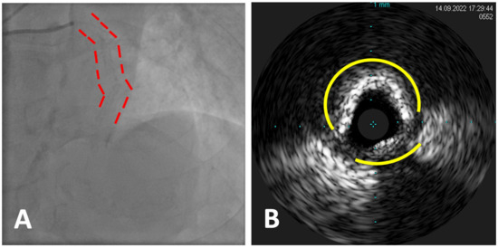 JCDD | Free Full-Text | Coronary Artery Calcium and Aging ...