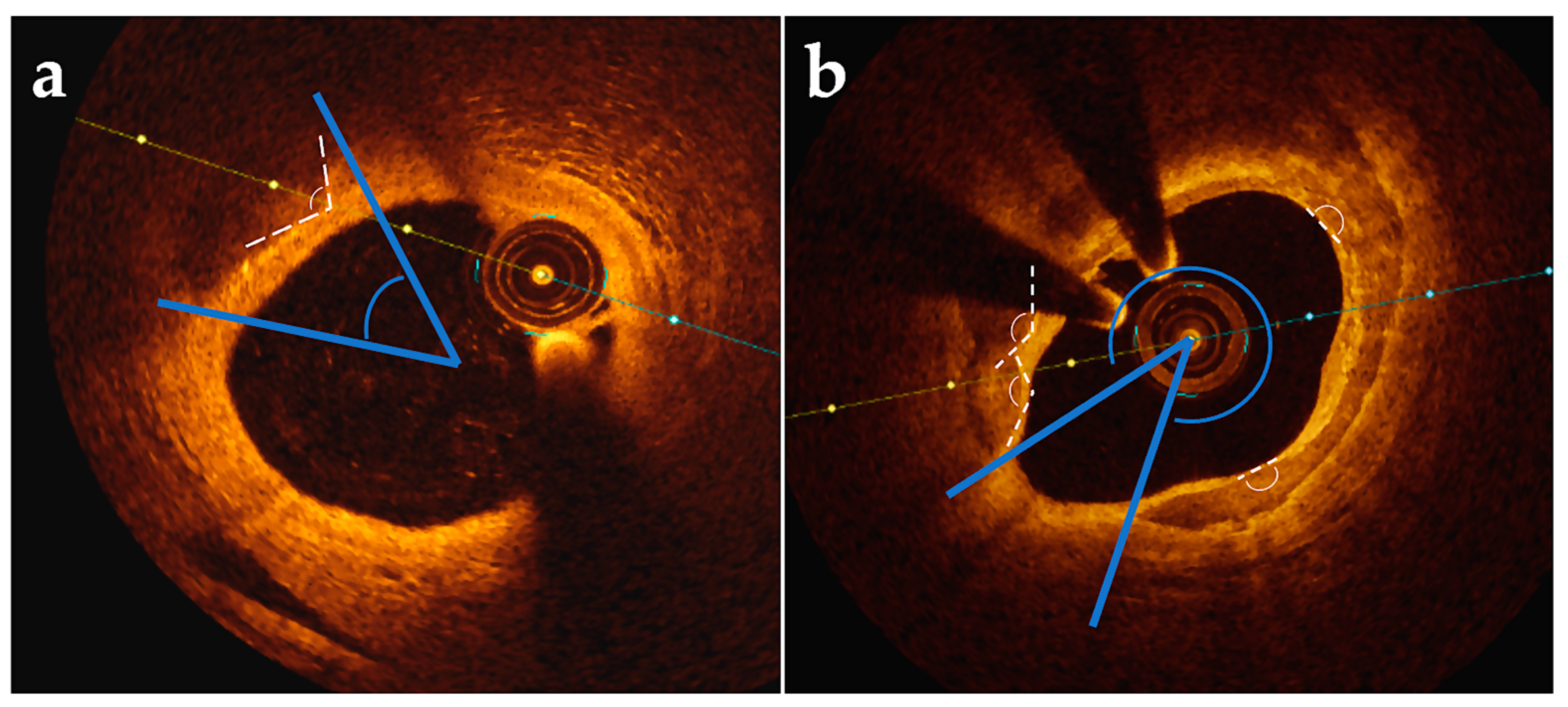 A Review Paper on Optical Coherence Tomography Evaluation of Coronary ...