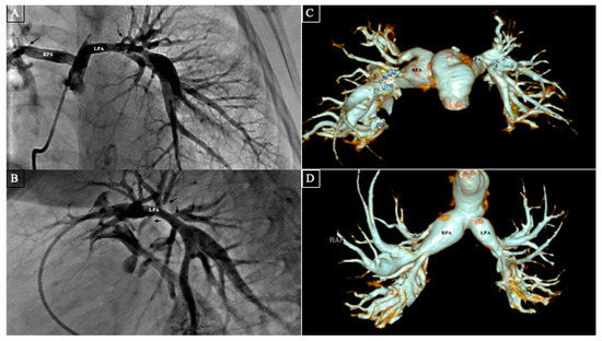 Complex Pulmonary Artery Rehabilitation in Children with Alagille ...