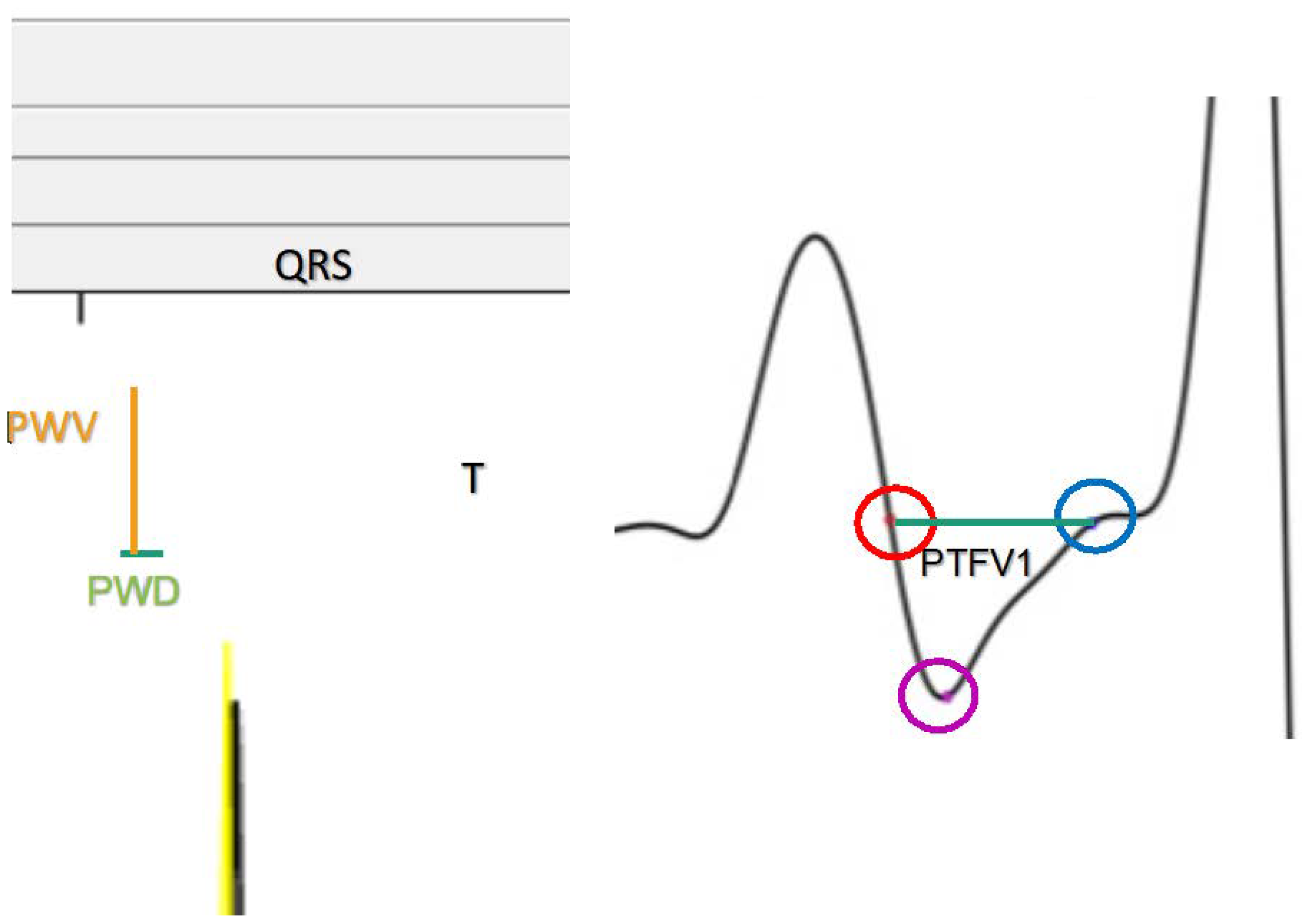 The Role of P Wave Parameters in Predicting Pulmonary Vein Isolation ...