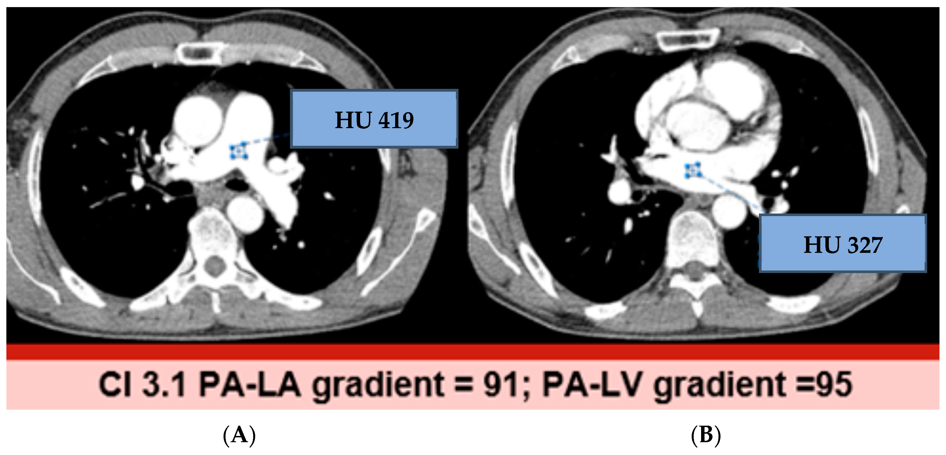Novel Computed Tomography Angiography Parameter Is Associated with Low ...