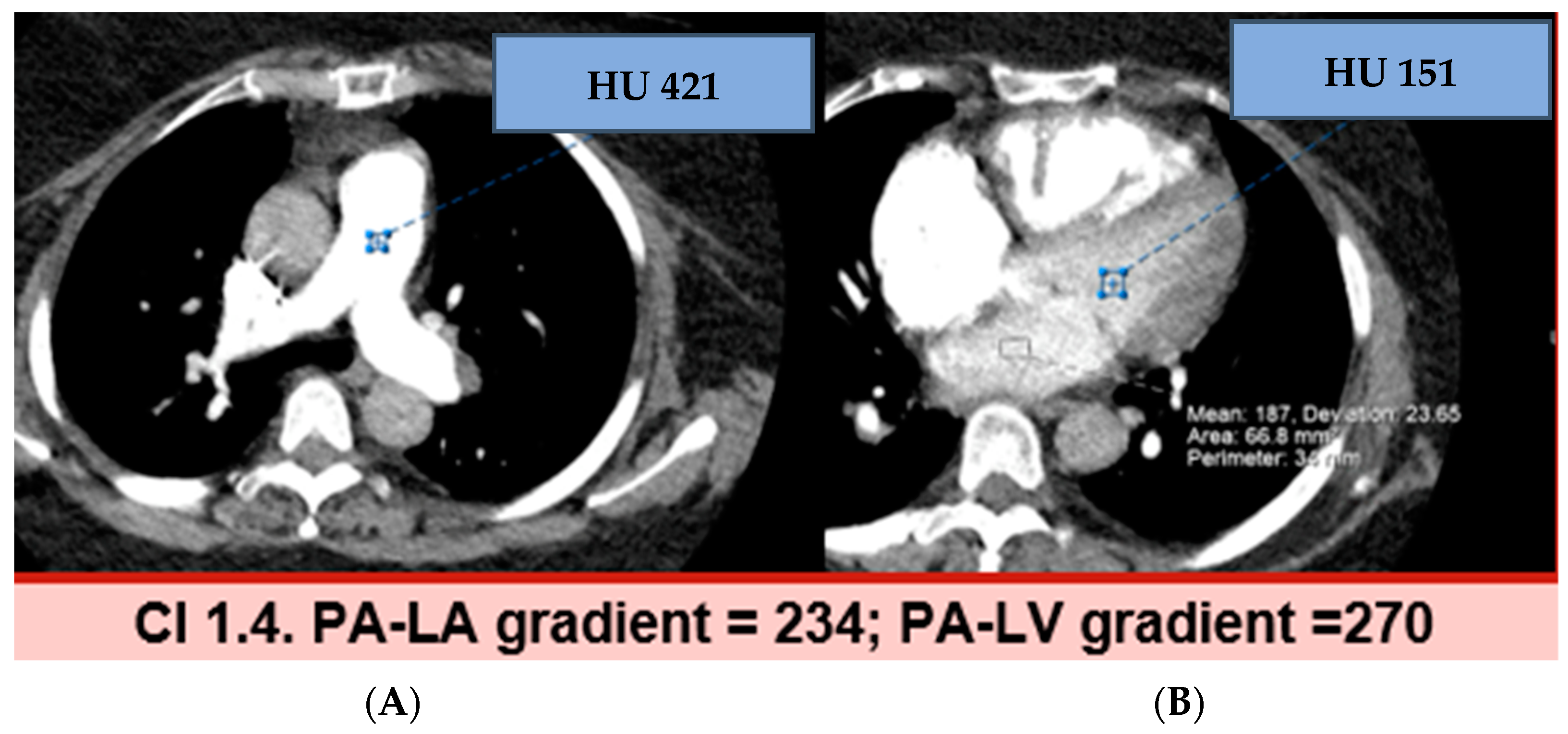 Novel Computed Tomography Angiography Parameter Is Associated with Low ...