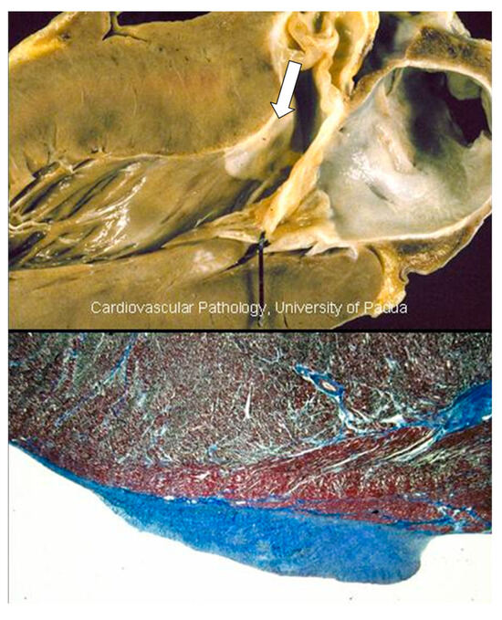 Storytelling of Hypertrophic Cardiomyopathy Discovery
