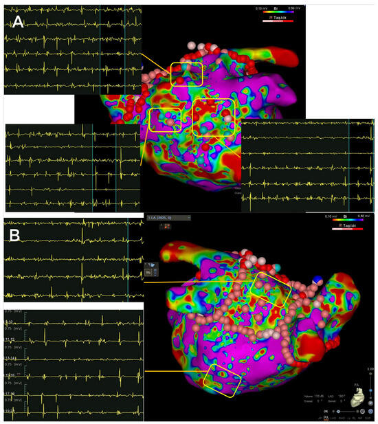 Effect of Pulmonary Vein Isolation with Left Atrial Wall Isolation Plus Selective CFAE Ablation ...