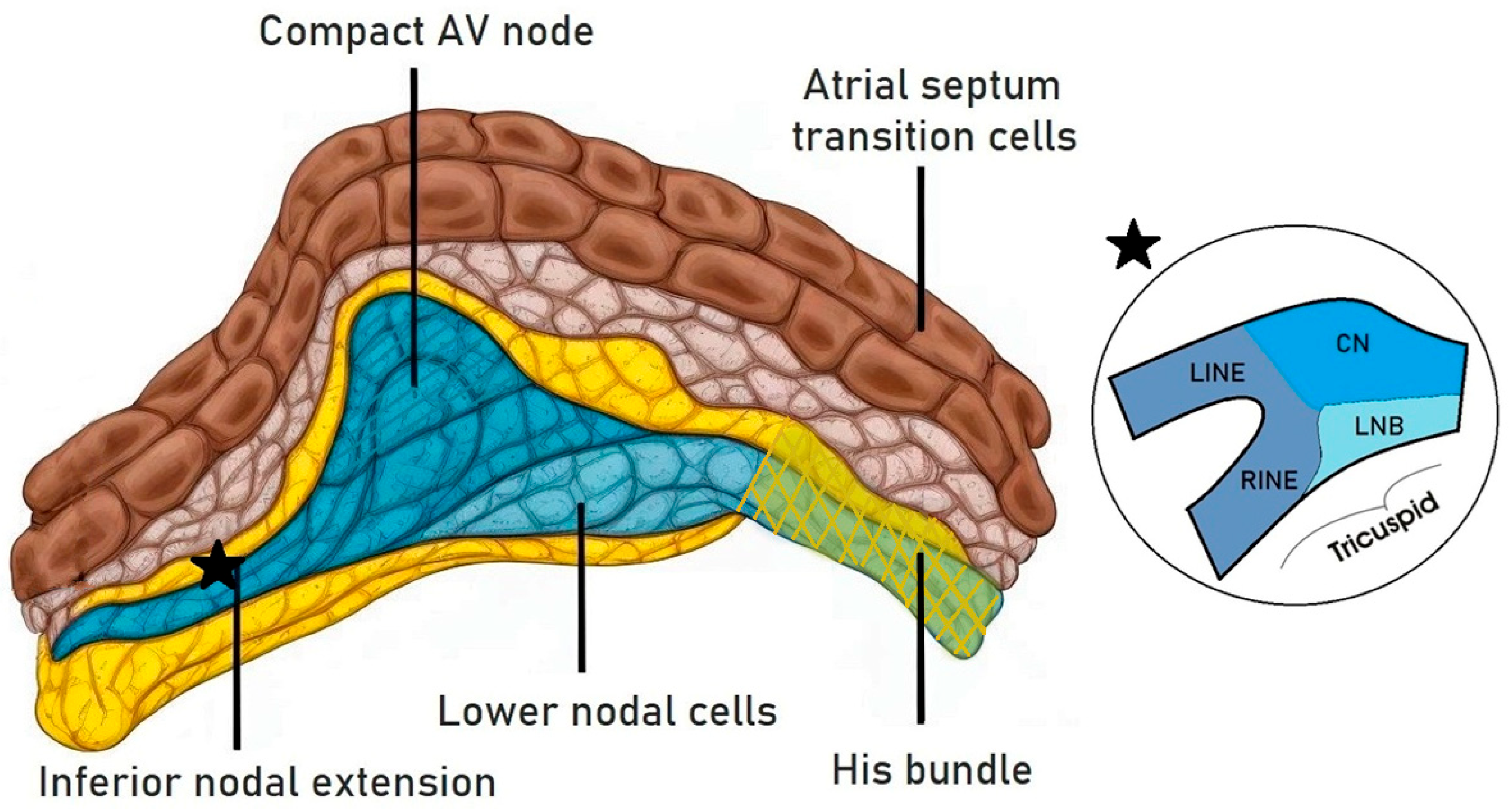 Relevance of Anatomical Significance of AV Nodal Structures within Koch’s Triangle and Pyramid