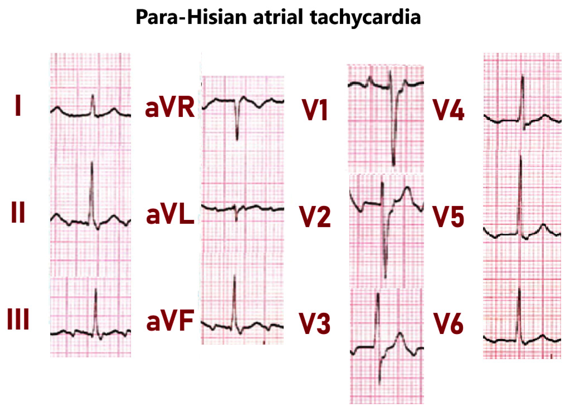 Relevance of Anatomical Significance of AV Nodal Structures within Koch ...