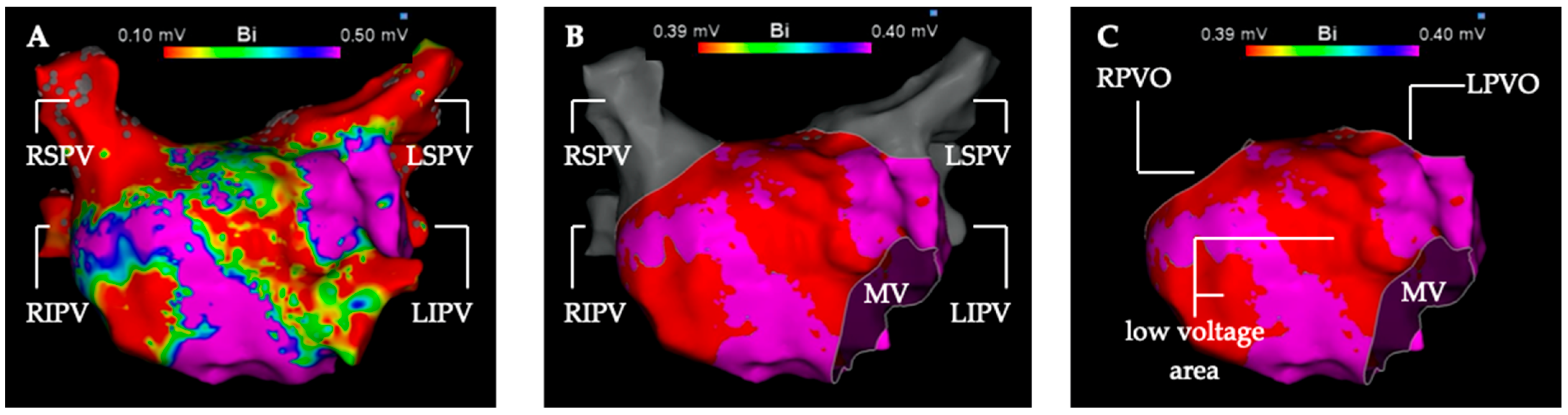 Left Atrial Low-Voltage Extent Predicts the Recurrence of Supraventricular Arrhythmias