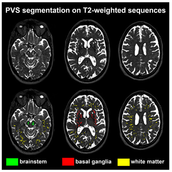 Clinical Relevance of Different Loads of Perivascular Spaces According ...