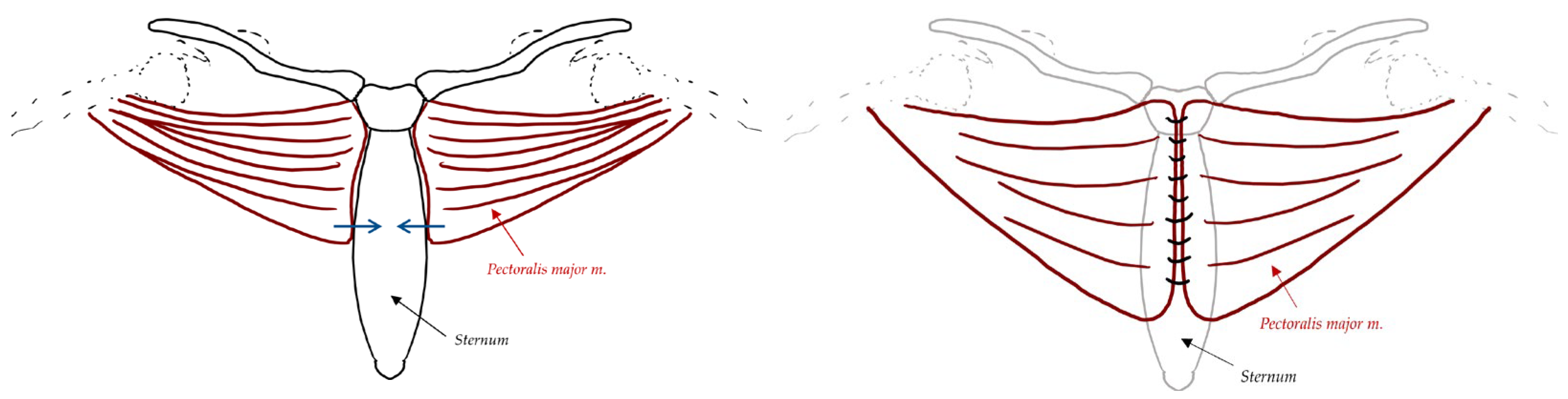 Sternal Wound Reconstruction Following Deep Sternal Wound Infection ...