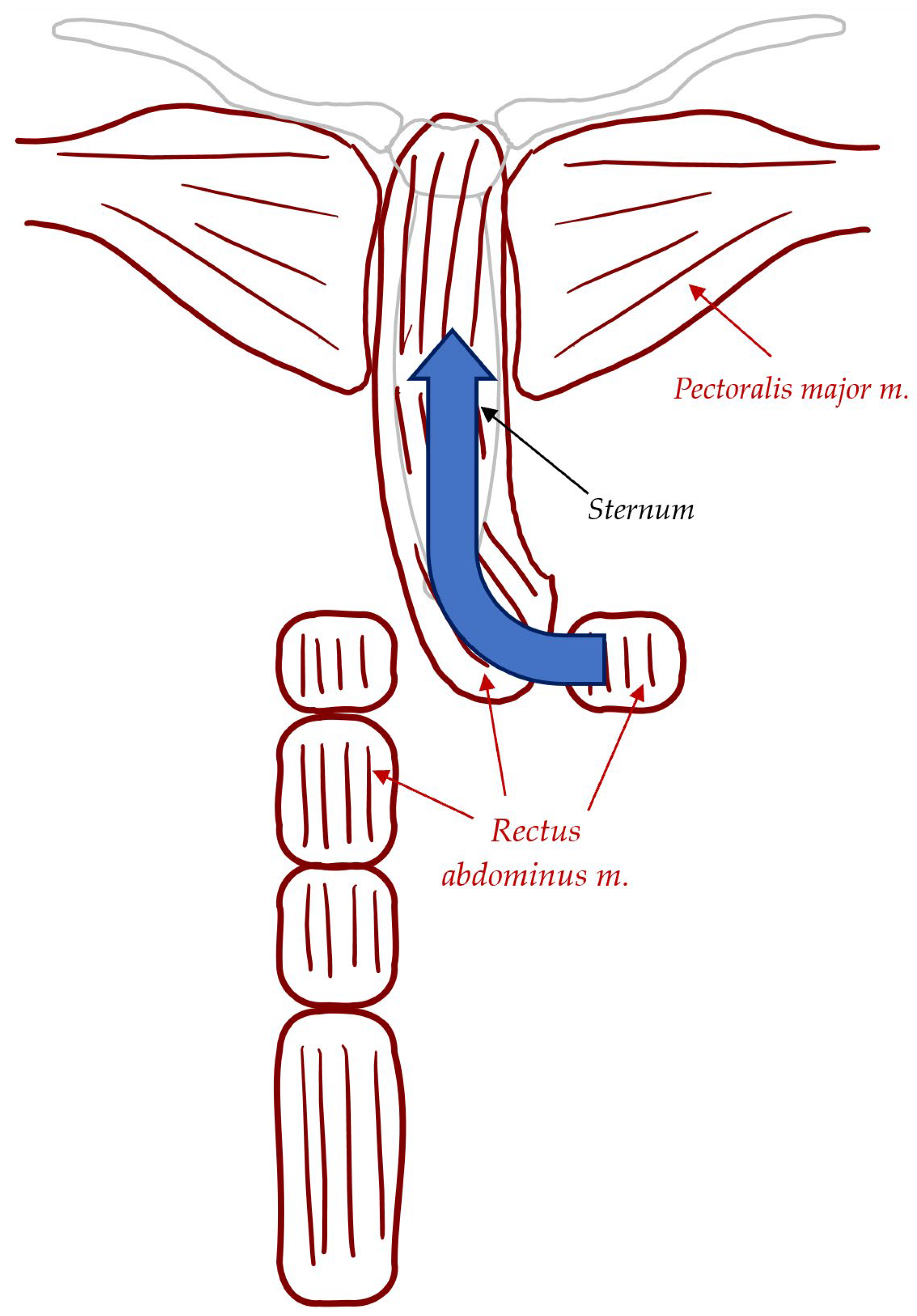 Sternal Wound Reconstruction Following Deep Sternal Wound Infection ...