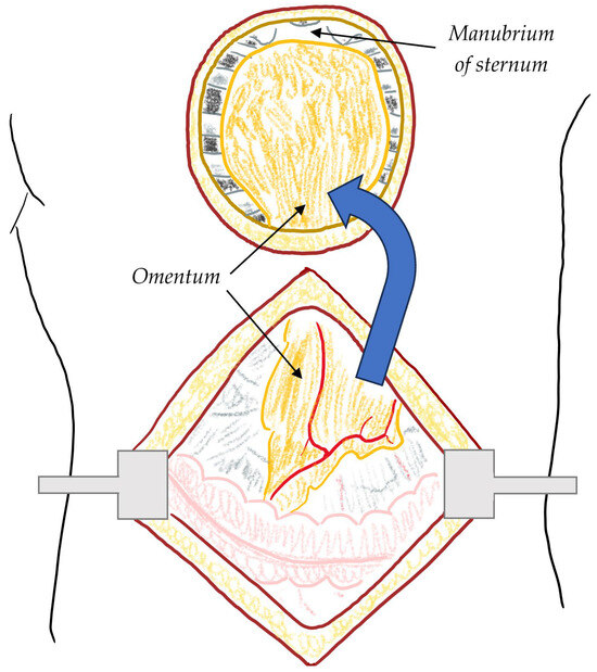 Sternal Wound Reconstruction Following Deep Sternal Wound Infection ...