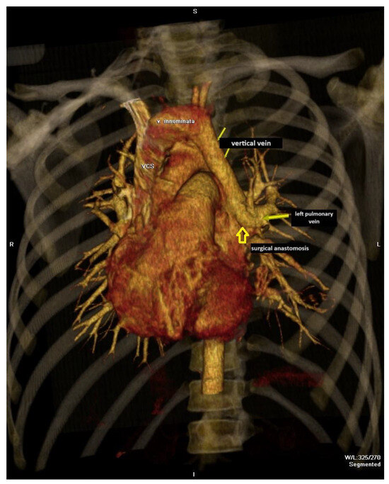 Percutaneous Embolization of No Ligated Vertical Veins After Total ...