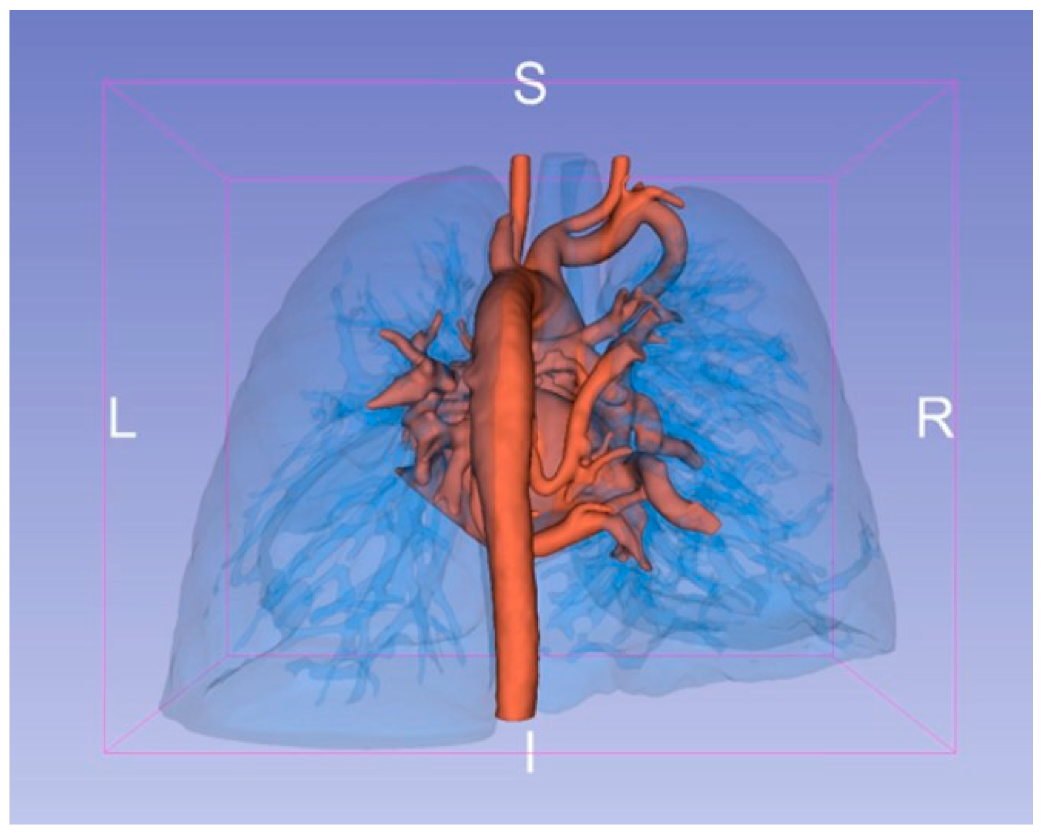 Unifocalization of Major Aortopulmonary Collateral Arteries (MAPCAs) and Native Pulmonary ...