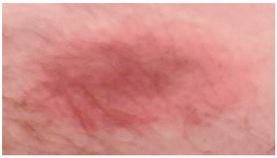 Cardiac Magnetic Resonance Imaging in Lyme Carditis—A Case Series and ...