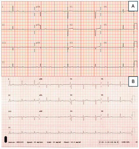 Cardiac Magnetic Resonance Imaging in Lyme Carditis—A Case Series and ...