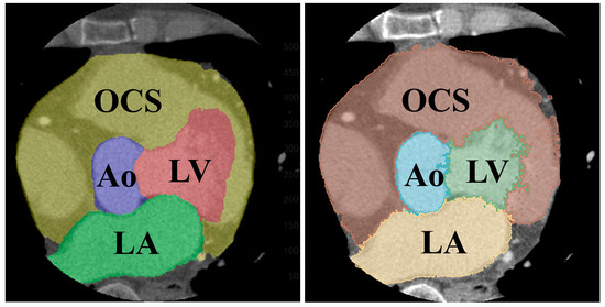 Automatic Aortic Valve Extraction Using Deep Learning with Contrast-Enhanced Cardiac CT Images