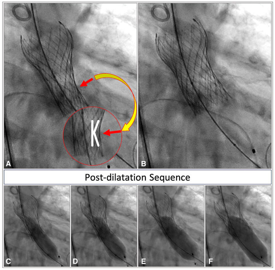 Raphe-Type Bicuspid Aortic Valve as a Risk Factor for Transcatheter ...
