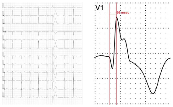 Papillary Muscles of the Left Ventricle: Integrating Electrical and ...