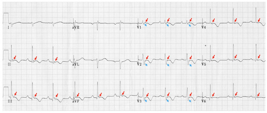 Arrhythmogenic Right Ventricular Cardiomyopathy: A Comprehensive Review