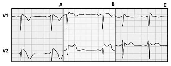 Brugada Syndrome and Exercise: Is It Time for a Paradigm Change?