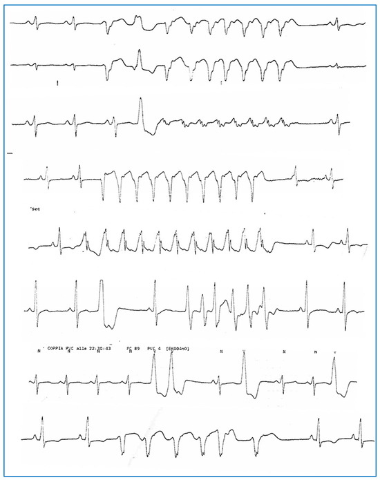 Dilated Cardiomyopathy: A Novel BAG3 Mutation Associated with ...