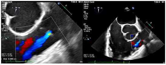Perioperative Considerations, Anesthetic Management and Transesophageal ...