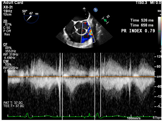 Perioperative Considerations, Anesthetic Management and Transesophageal ...