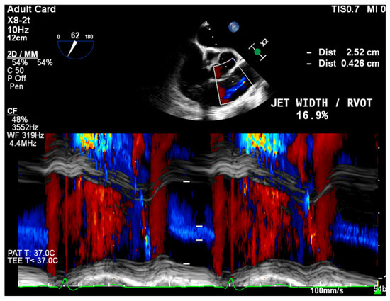 Perioperative Considerations, Anesthetic Management and Transesophageal ...