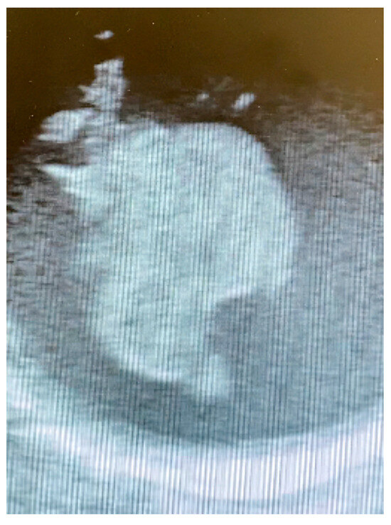 Optimal Management of Spontaneous Aortic Thrombus Floating in the ...