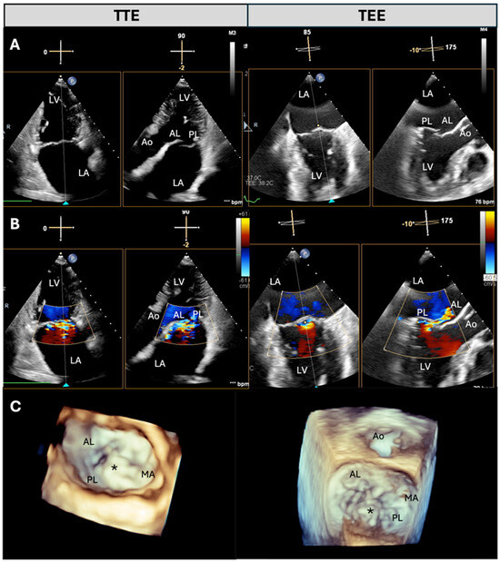 Echocardiographic Screening for Transcatheter Edge-to-Edge Mitral Valve ...