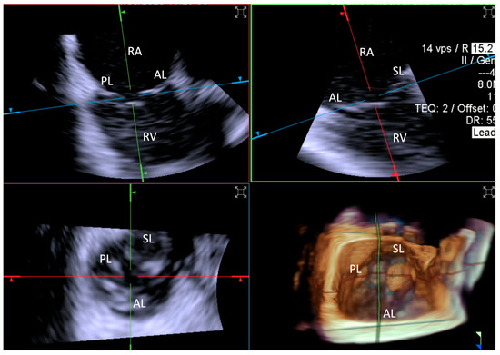 Early Experience with Acuson AcuNav 4D-ICE to Guide Transcatheter ...