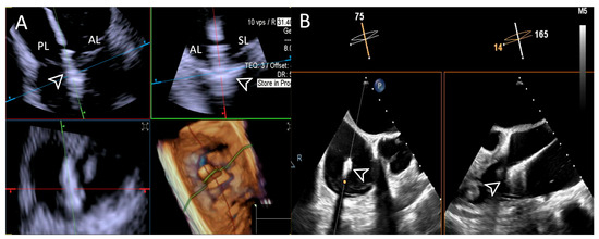 Early Experience with Acuson AcuNav 4D-ICE to Guide Transcatheter ...